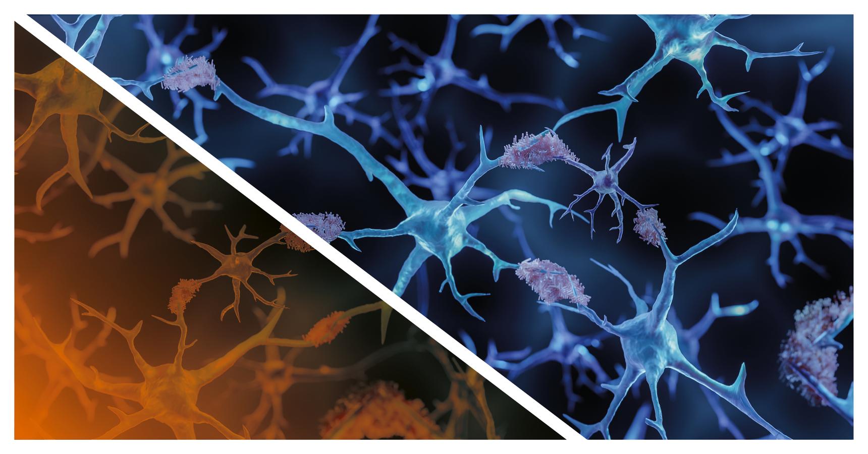 Understanding neurodegenerative diseases